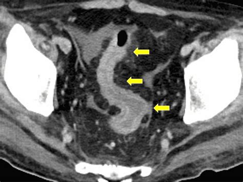 Contrast Enhanced Computed Tomography Computed Tomography Showing Download Scientific Diagram