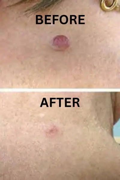 Best Skin Tag Removal Solution In Leicestershire Uk
