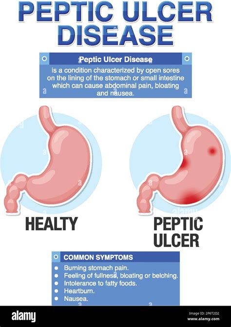 Peptic Ulcer Disease Explained Infographic Illustration Stock Vector