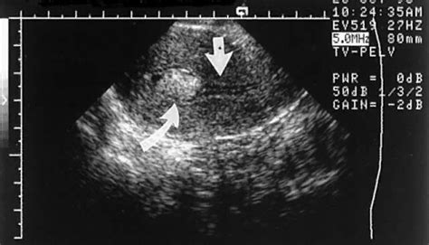 Volume 1 Chapter 124 Role Of Sonography And Hysterosonography In