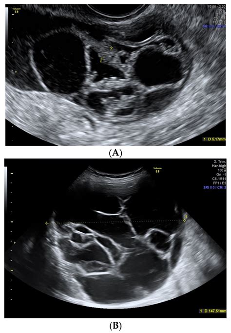 Mucinous Cystadenoma Ultrasound