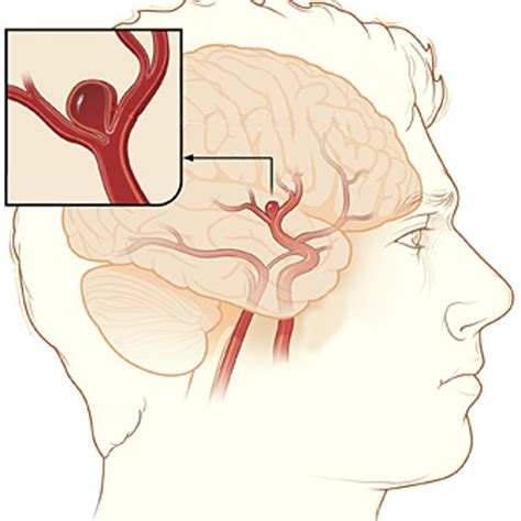 2 Schematic Drawing Of A Cerebral Aneurysm Located At A Vessel