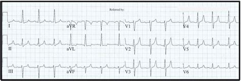 Hyperkalemia In A Young Woman With Type 1 Diabetes Mellitus