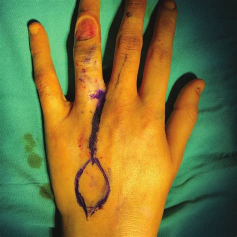 The Perforator Located Between The Third And Fourth Metacarpal Bones Download Scientific Diagram