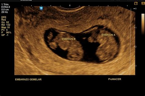Embarazo De Gemelos