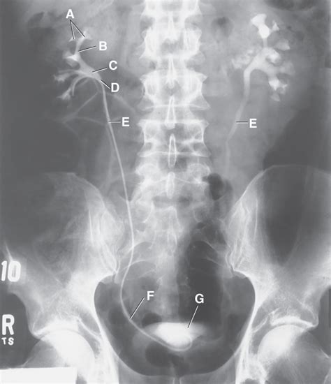 Retrograde Pyelogram Diagram Quizlet