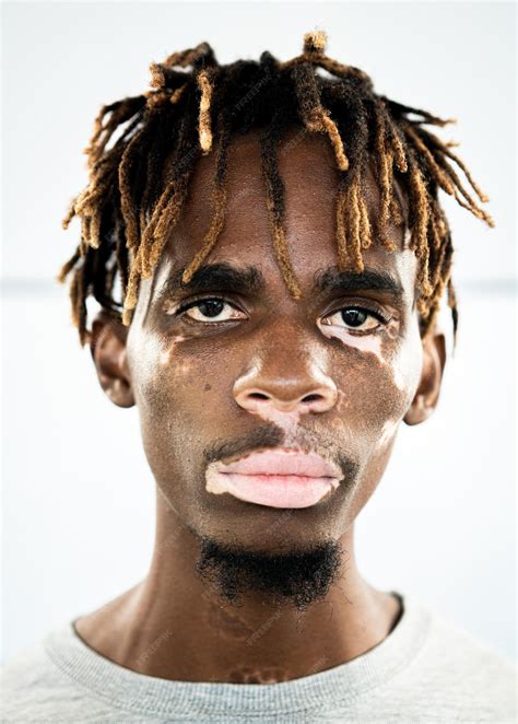 Premium Photo African American Black Young Man With Vitiligo Skin