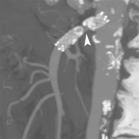 Thick Slab Maximum Intensity Projection Mip Image Confirming The Download Scientific Diagram