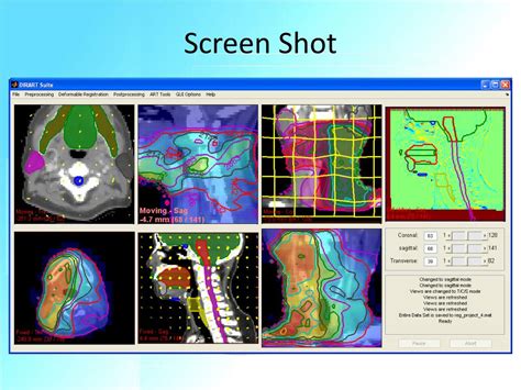 Ppt Dirart The Deformable Image Registration Adaptive Radiotherapy Software Suite Powerpoint