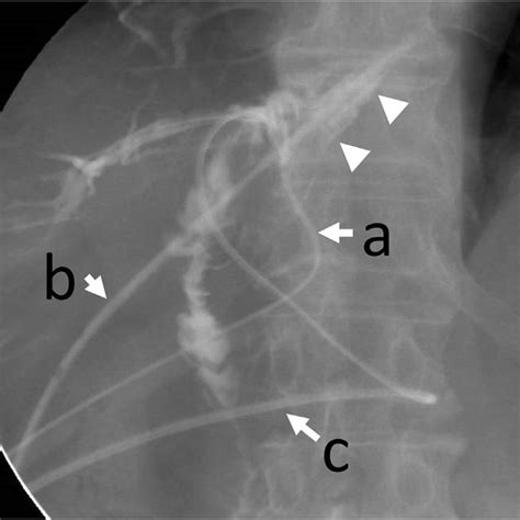Postoperative Cholangiography Through A Trans Anatomic Biliary Drainage