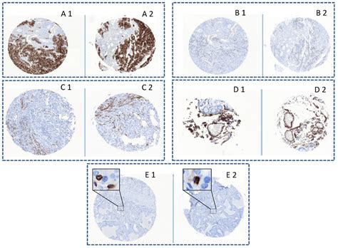 Microarrays Special Issue 15 Years Of Tissue Microarray Technology