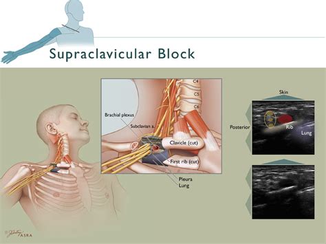 Supraclavicular Nerve Block