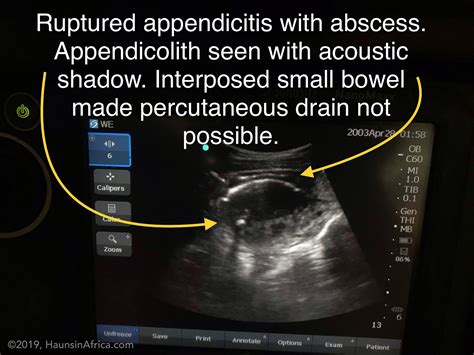 Ruptured Appendix Ultrasound