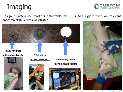 Custom Endoprotesi Design Of Patient Specific Ankle Prosthesis For