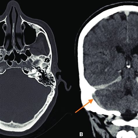 A 52 Year Old Woman Complaining Of Holocranial Headache A Axial Ct