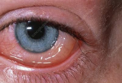Eye Allergic Conjunctivitis And Conjunctival Oedema Stock Image M1550317 Science Photo Library
