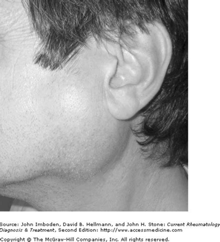 Pmr Scleroderma Polymyositis And Dermatomyositis Flashcards Quizlet