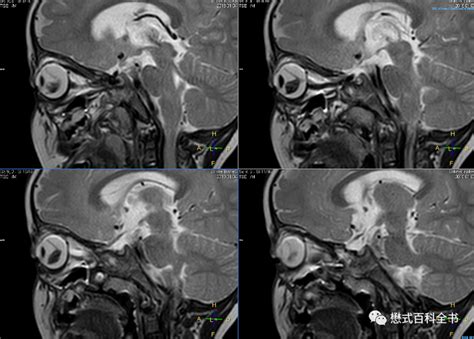 磁共振眼眶规范扫描及技术应用 知乎