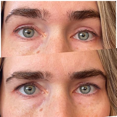 Upperlower Bleph Or Brow Lift Rplasticsurgery