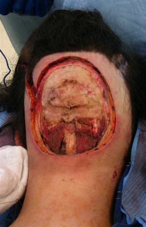 Tissue Expander Use For Reconstruction Of Scalp Soft Tissue Sarcoma