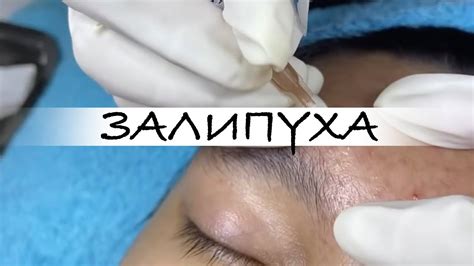 ПРЫЩИ ВЫДАВЛИВАНИЕ ️ ПОДБОРКА ВЫДАВЛИВАНИЕ ПРЫЩЕЙ прыщи Acne Asmr Youtube