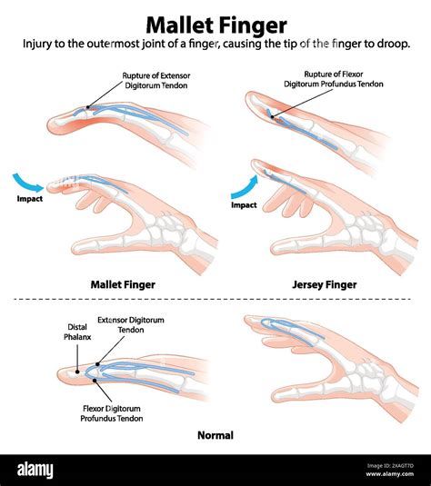 Illustration Of Finger Tendon Injuries And Normal Anatomy Stock Vector Image And Art Alamy