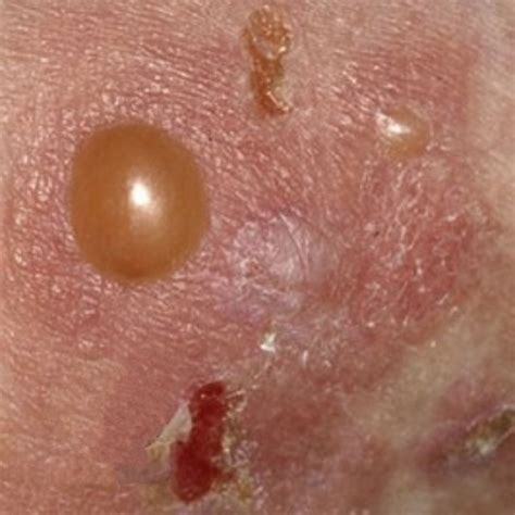 Do Not Be Rash With Rashes A Guide To Dermatological Description Rcemlearning India