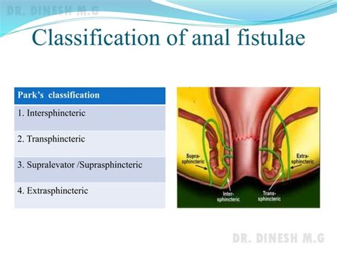Anorectal Abscess And Anal Fistulae