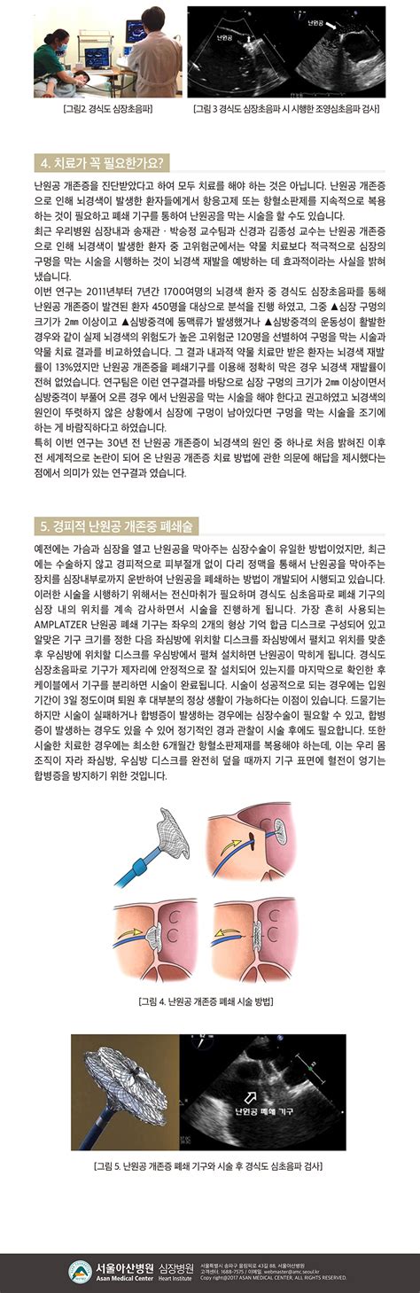 [아산심장소식지 2018년 가을호] 난원공 개존증 아산심장소식지 일반인정보 심장병원 서울아산병원