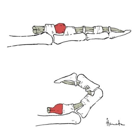 Trigger Finger Pathophysiology Release Teachmesurgery