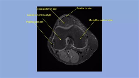 Mri Knee And Ankle Anatomy Presentation Pk1 Pptx