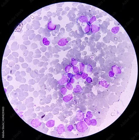 Leukemia Blood Cells Blast Cells And Immature Leukocytic Cells In