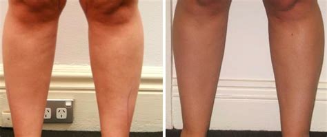 Calfankle Liposuction Sydney Gold Coast Canberra Adelaide