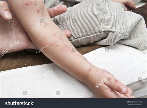 102 Dermatome 이미지 스톡 사진 및 벡터 Shutterstock