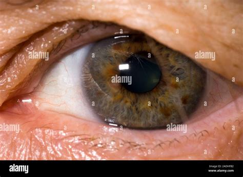 Model Released Pigmented Iris Naevus Dark Patch Centre Left In A 67 Year Old Womans Iris Model Released Pigmented Iris Naevus Dark Patch Centre Left In A 67 Year Old Womans Iris