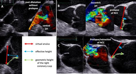 Aortic Valve Cusps Echo
