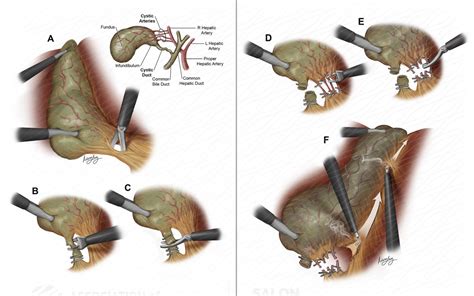 Cholecystectomy With Multiple Cystic Arteries Ami Meeting 2021