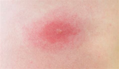 Как выглядит укус клеща фото и симптомы