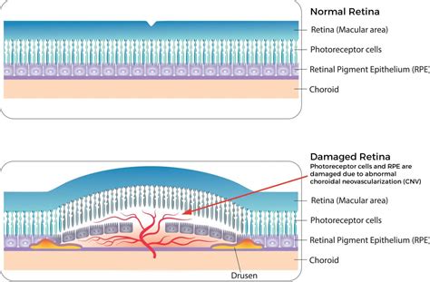 What Is Best Disease Best Vitelliform Macular Dystrophy