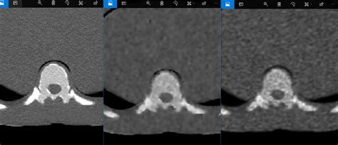 Denosing Lung Ct Scans Using Neural Networks With Interactive Code — Part 4 Convolutional