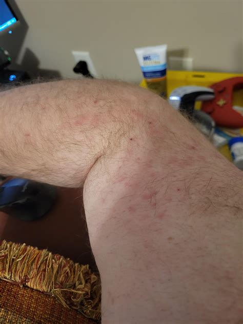 Scabies Eczema Or Other Rdermatologyquestions