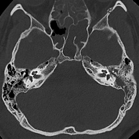 Ossicular Chain Disruption Pacs