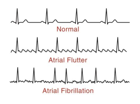 Atrial Flutter Flashcards Quizlet