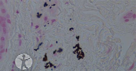 Pseudoxanthoma Elasticum Pathology Image