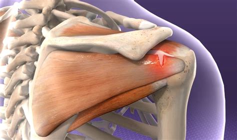 Rotator Cuff Tear Vs Muscle Strain At Dean Hammock Blog
