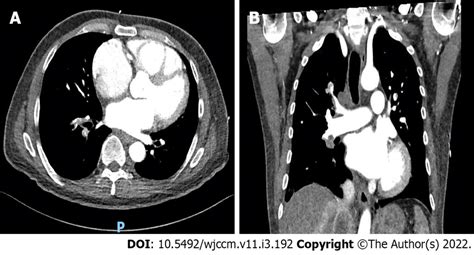 Large Filling Defects In The Right Segmental And Subsegmental Branches Download Scientific