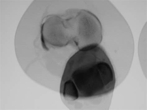 Example Of CT Scan Overlapping Of The Proximal And Distal Tibia To Download Scientific Diagram