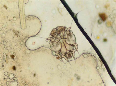 Scabies A Neglected Parasitic Disease We Already Know How To Treat