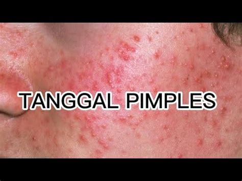 MABISANG GAMOT SA PIMPLES YouTube
