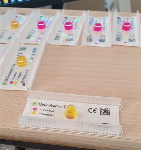 궤양에 의한 위아전절제술 Billroth Ii 받은 분의 만성 표재성 위염 소견 헬리코박터 음성 담즙 역류 위염